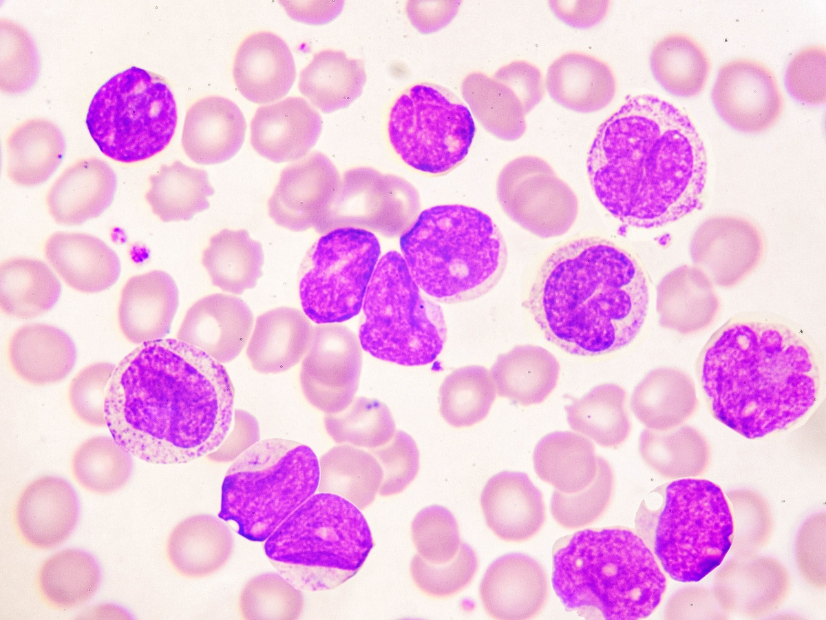 Leucemia Acuta Promielocitica: informati | AIL