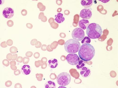 Leucemia Mieloide Acuta